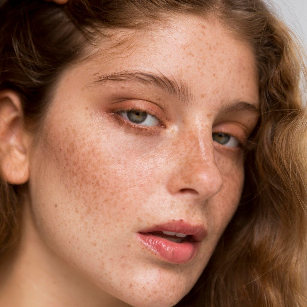 Melasma – Lumish